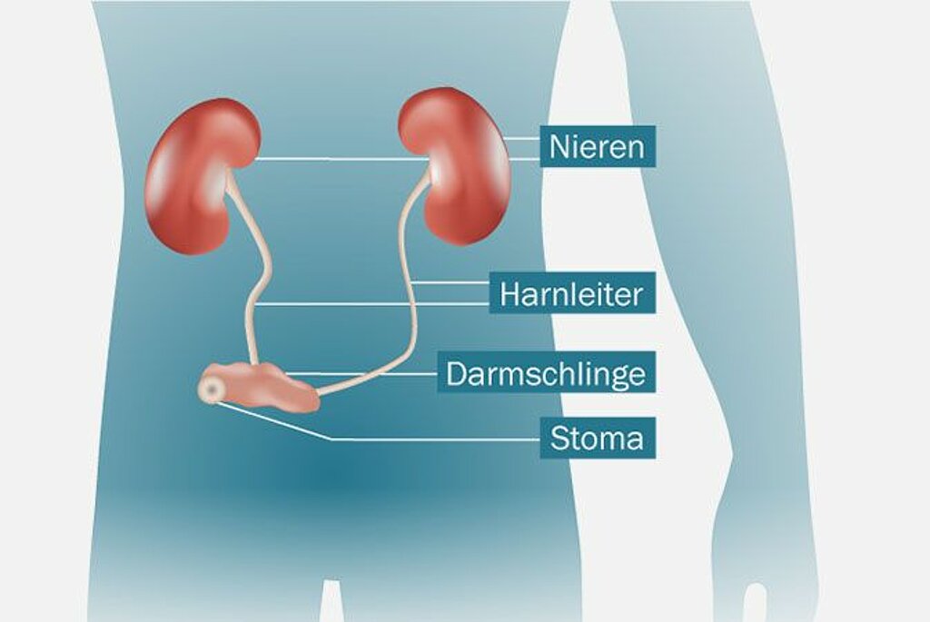 Formen von Blasenersatz bei Krebs | Das K Wort